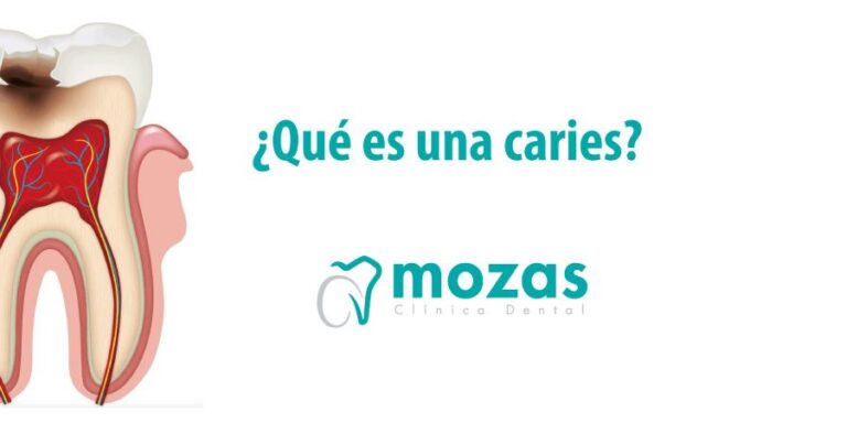 ¿Qué es la caries dental - Alimentos101.com